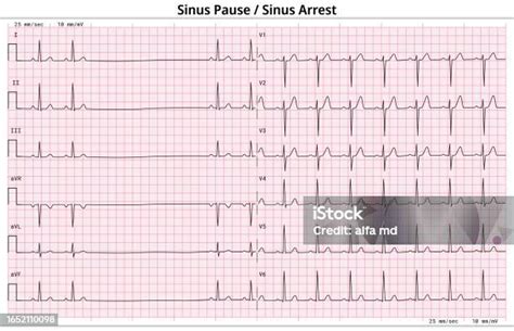 부비동 정지 부비동 일시 중지 Ecg 용지 12 리드 건강 진단에 대한 스톡 벡터 아트 및 기타 이미지 건강 진단 건강
