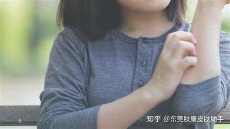 能够快速止痒的小方法 知乎