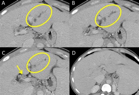 Appearance Of Psc On Ct Ac There Is Irregular Dilatation Of The