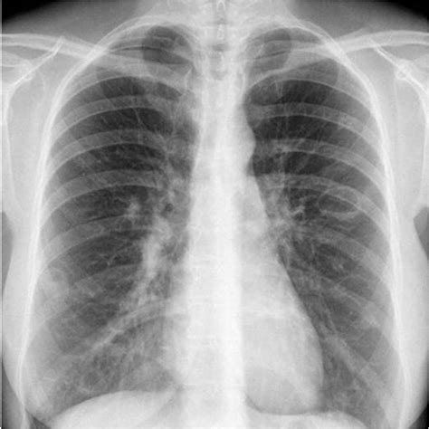 Figure 1 Chest Radiograph August 2007 Bilateral Nodular Shadowing