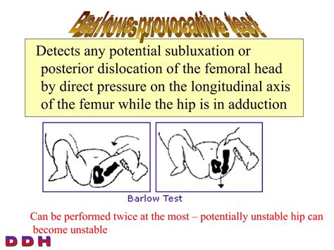 Ddh Developmental Dysplasia Of The Hip Ppt