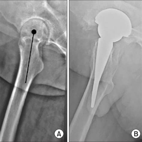 Anatomical Restoration Of The Hip Center With Metha Short Stem