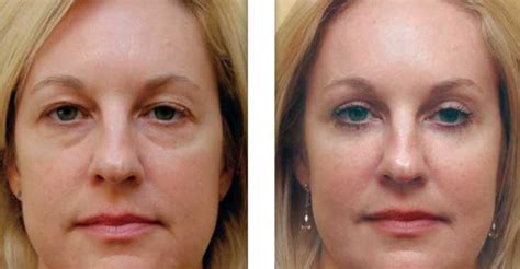 Is Blepharoplasty Right For You Procedure Side Effects Cost Before