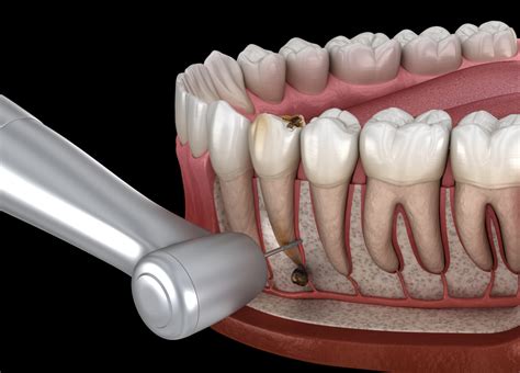 When A Tooth Needs Root Canal Surgery El Paso Tx