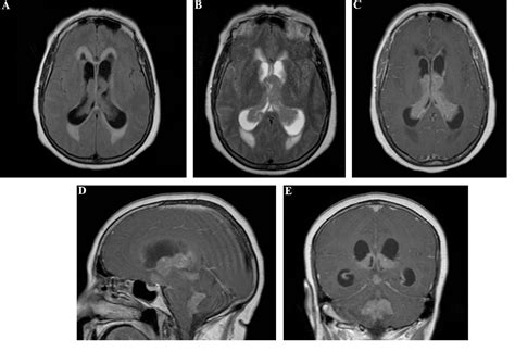 Figure 1 From Primary Diffuse Choroid Plexus T Cell Lymphoma Case Report Semantic Scholar