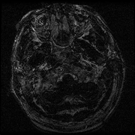 Acoustic Schwannoma Radiopaedia 39170 41387 Axial Fiesta Nc Commons