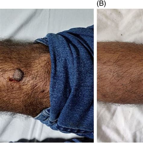 A Verruca Vulgaris Over Medial Aspect Of The Right Great Toe B Download Scientific Diagram