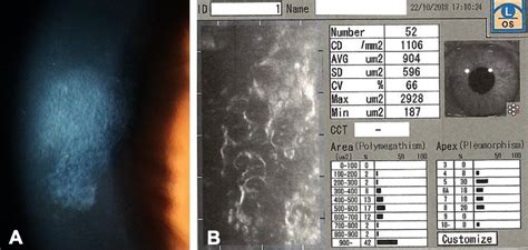 A High Magnification Slit Lamp Specular Reflection Image Of A Cornea