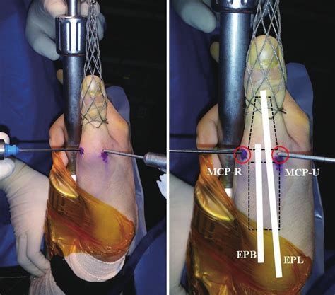 Arthroscopic Portals Of The Metacarpophalangeal Joint Of The Thumb Download Scientific Diagram