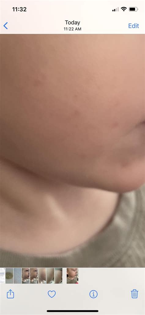 New Pimples R Scabies