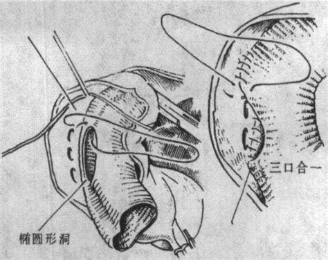 端 端吻合法 心血管 医学