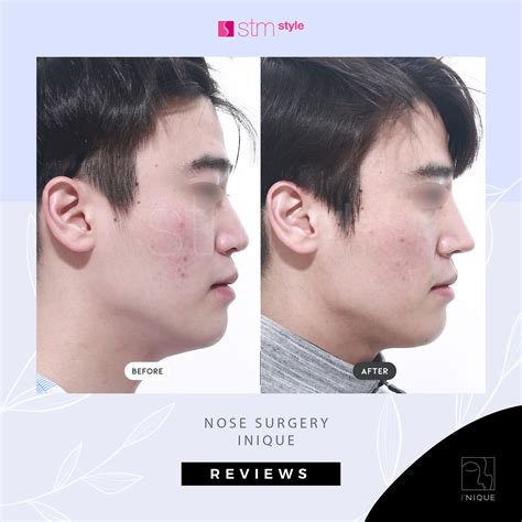 Nose Surgery Augmentation And Refinement Of The Nasal Tip Stm Style