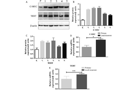 C Myc And Htert Expression In Primary Gastric Cancer And Local Download Scientific Diagram