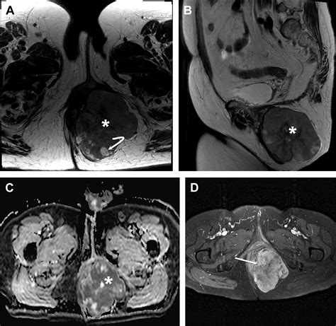 Mr Imaging Of Vulvar And Vaginal Cancer Magnetic Resonance Imaging