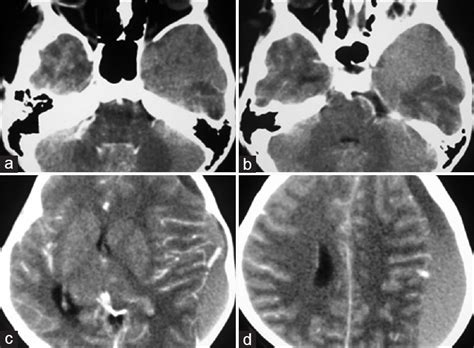 Spontaneous Intracystic Hemorrhage Complicating An Intracranial