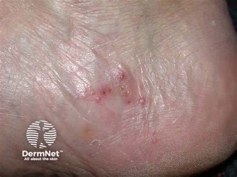 Tinea Pedis Blisters Severe Dry Flaky Athletes Foot Infection