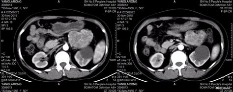 胰腺浆液性囊腺瘤一例