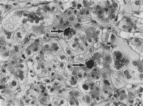 Canalicular Bilirubinostasis In A Field Which Also Contains