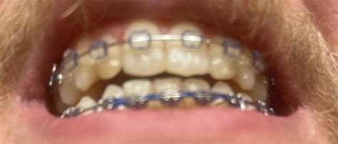 Only 3 Lower Incisors But This Is Underbiteclass Iii I Dont Want