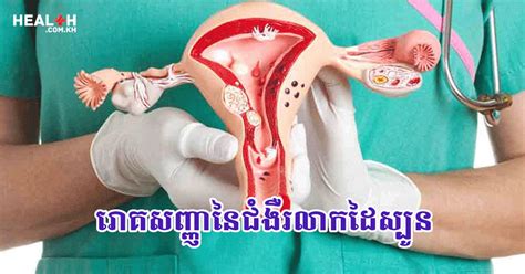 រោគសញ្ញា នៃ ជំងឺ រលាក ដៃ ស្បូន Kh