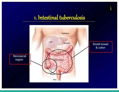 Tb And Typhoid Lesions Of Small Intestine Pptx