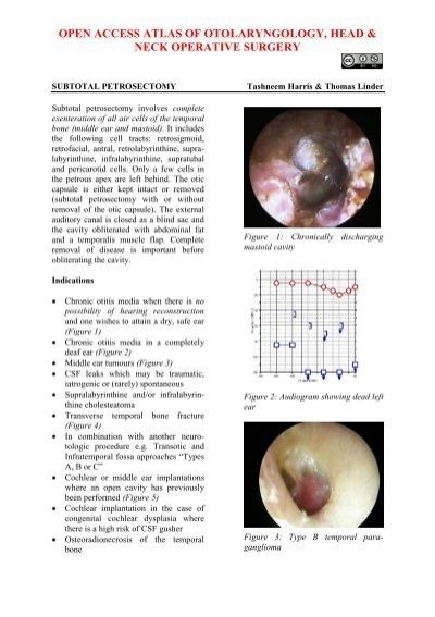 Subtotal Petrosectomy Vula University Of Cape Town