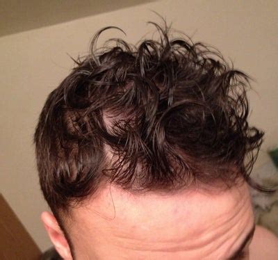 Is This Diffuse Thinning Year Old Male Photo Doctor Answers Tips