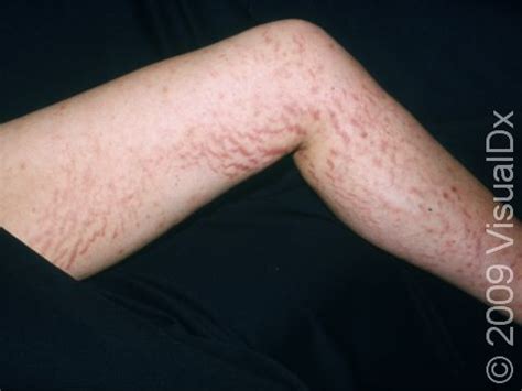 Stretch Marks On Thighs Pregnancy