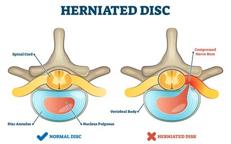 What Is A Herniated Disc The Science Behind Herniated Disc