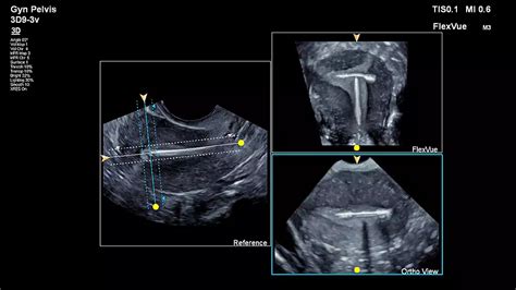 Flexvue Philips