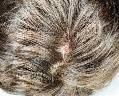 چگونه زخم پوست سر را به راحتی در منزل درمان کنیم؟