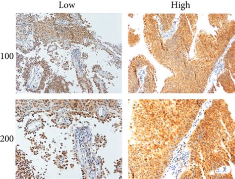 High Expression Of NUCB2 Was Linked To Poor Prognosis A