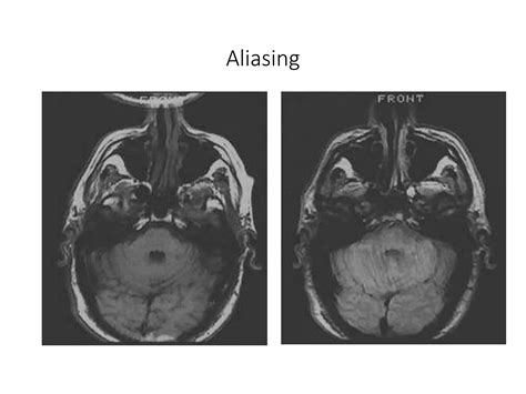 Mri Artifacts Introduction Classification Types Pptx