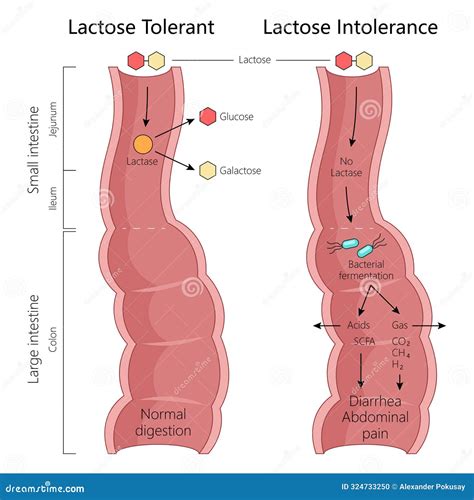 Lactose Tolerance Vs Intolerance Diagram Medical Royalty Free Cartoon 325463840