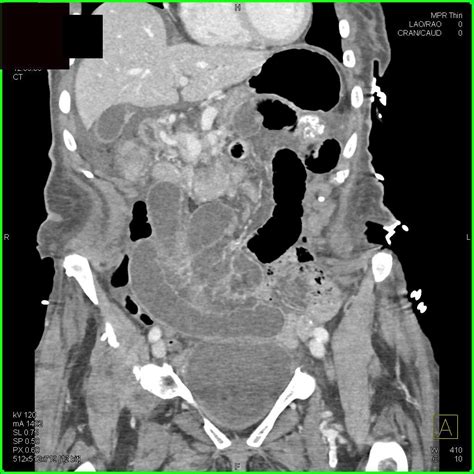 Small Bowel Obstruction Sbo With Internal Hernia Small Bowel