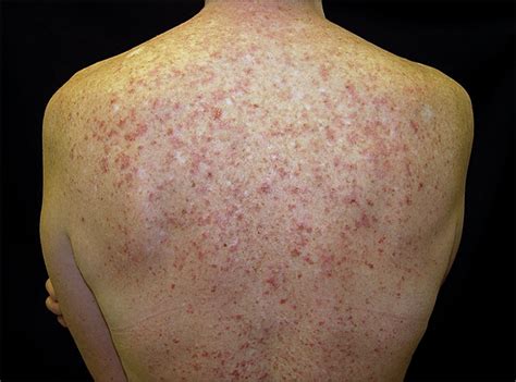 Lupus Dermatitis Medical Pictures Info Atopic Dermatitis