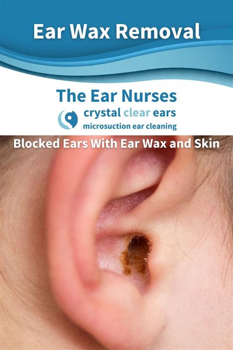 Blocked Ears With Ear Wax And Skin Artofit