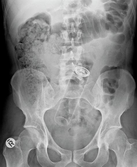 Deodorant Can In Mans Rectum Photograph By Du Cane Medical Imaging Ltdscience Photo Library