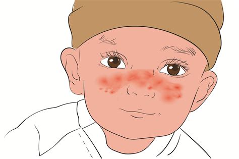 孩子红斑狼疮早期图片 百度健康·医学科普