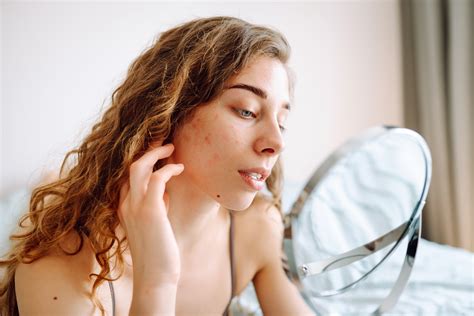 Así Puedes Prevenir Y Controlar La Alergia En Tu Piel Club Cruz Verde
