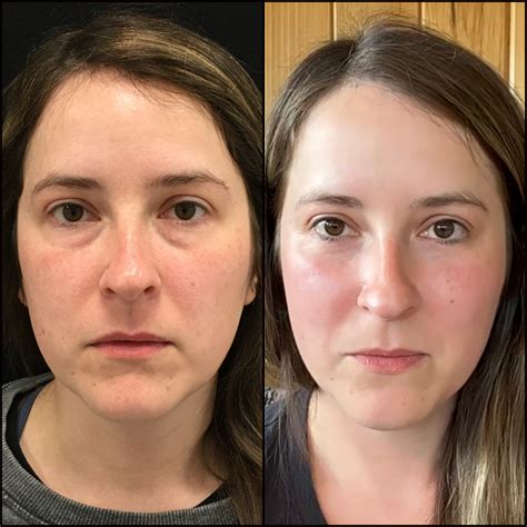Lower Blepharoplasty Before And After Doctorvisit