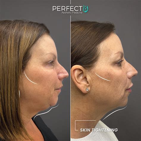 Skin Rejuvenation Treatment Perfect B