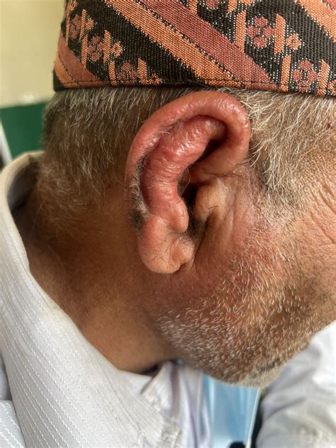 Perichondritis Management Antibiotics Of Choice Dranup Sanjel