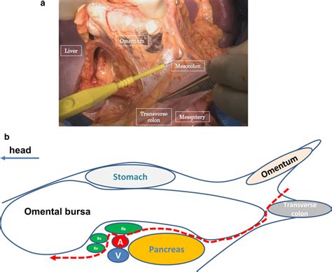 Illustrations Of Bursectomy For Advanced Gastric Cancer A Dissecting