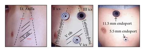 Schematic Of The Thoracoscopic Endoloop Ligation Procedure A