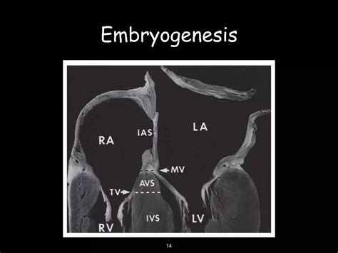 Atrioventricular Septal Defect Pptx Heart And Cardiovascular