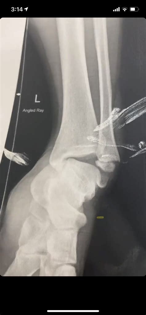 How Bad Is This Orif Ankle Fracture Just Had Surgery A Week Ago