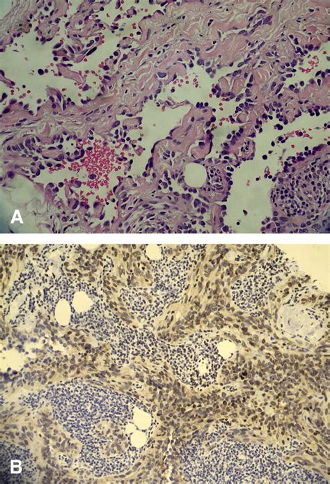 Lymphangiosarcoma Presenting As Asymptomatic Swelling Of The Cheek