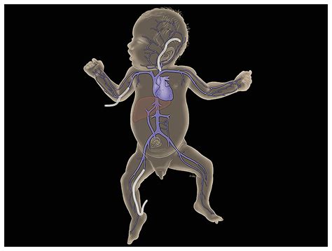 Picc Placement In The Neonate Nejm