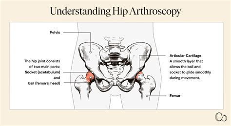 Hip Arthroscopy 101 — Procedure And Recovery Guide Commons Clinic